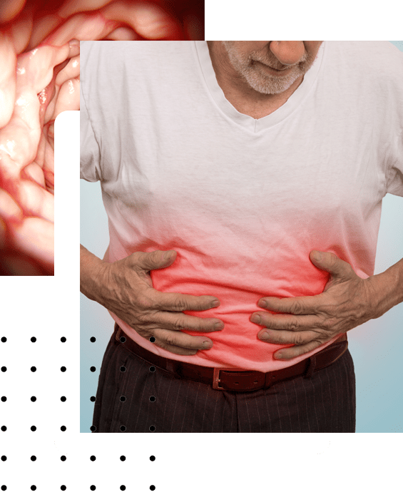Ulcerative Colitis